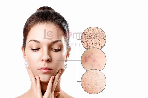 El acné hormonal, ¿qué es y cómo identificarlo?